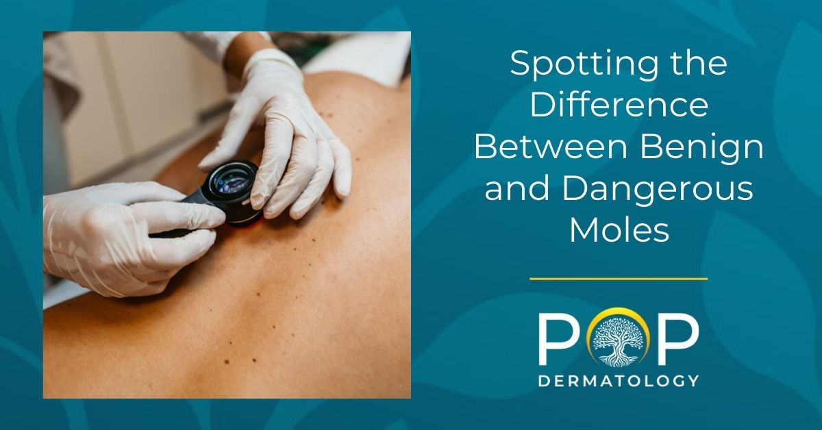 Spotting the Difference Between Benign and Dangerous Moles