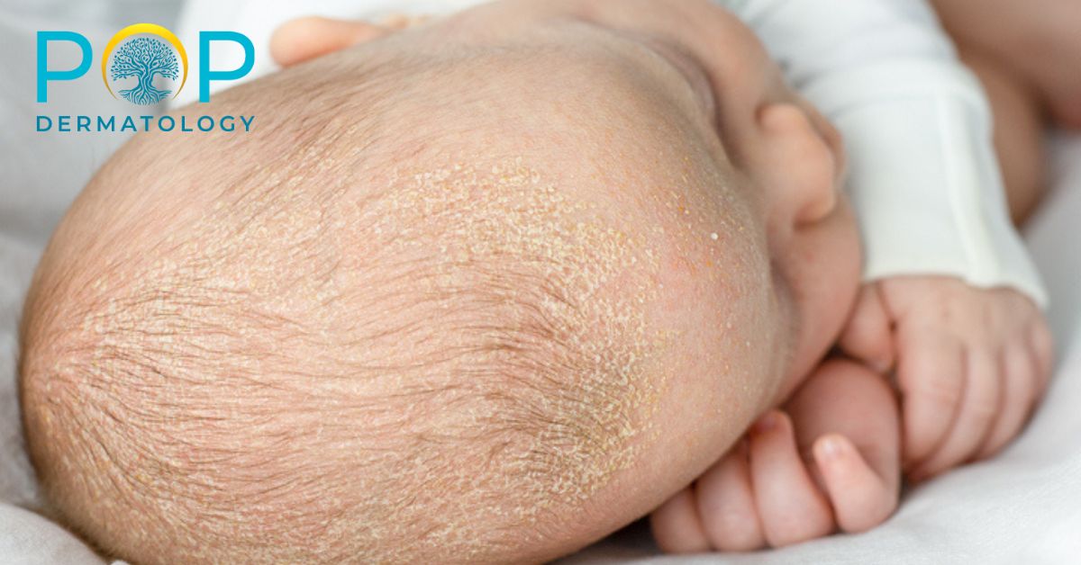 Dandruff, Alopecia, & Beyond: How to Manage Scalp Conditions in Children